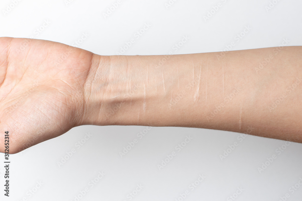 female hand close-up with scars from cuts by a blade. Stock Photo ...