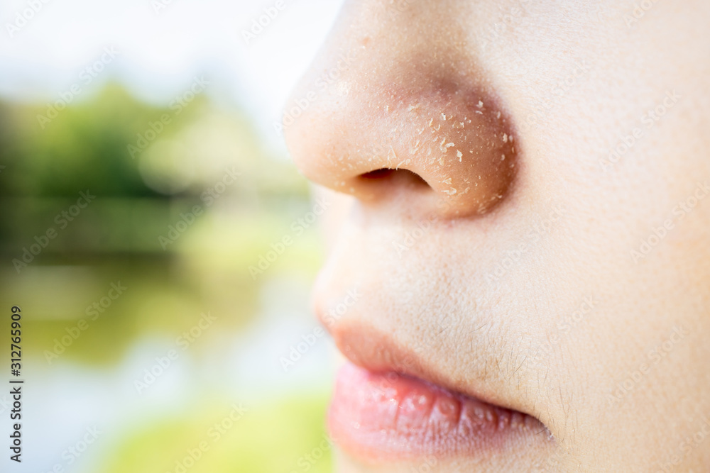 Allergic young woman have eczema dry nose on winter season,female people peeling skin with ...