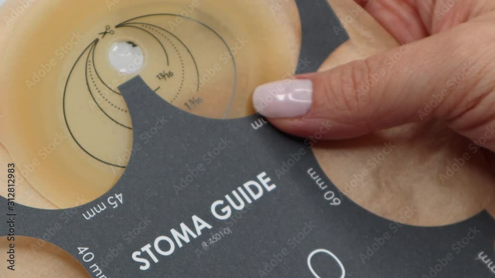 Zoom in colostomy bag, supply needed after colostomy surgery - colon ...