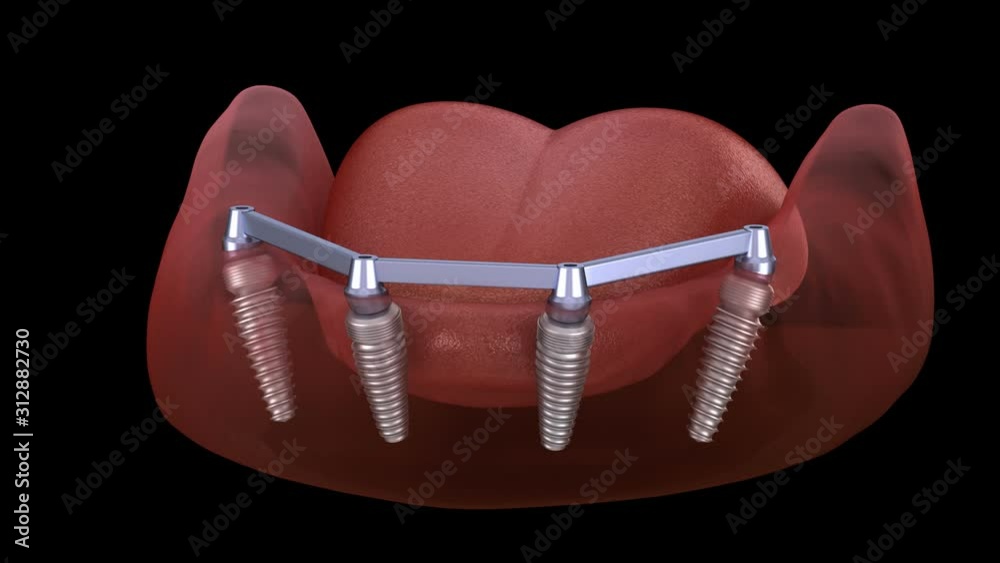 Removable Mandibular prosthesis with gum All on 4 system supported by ...