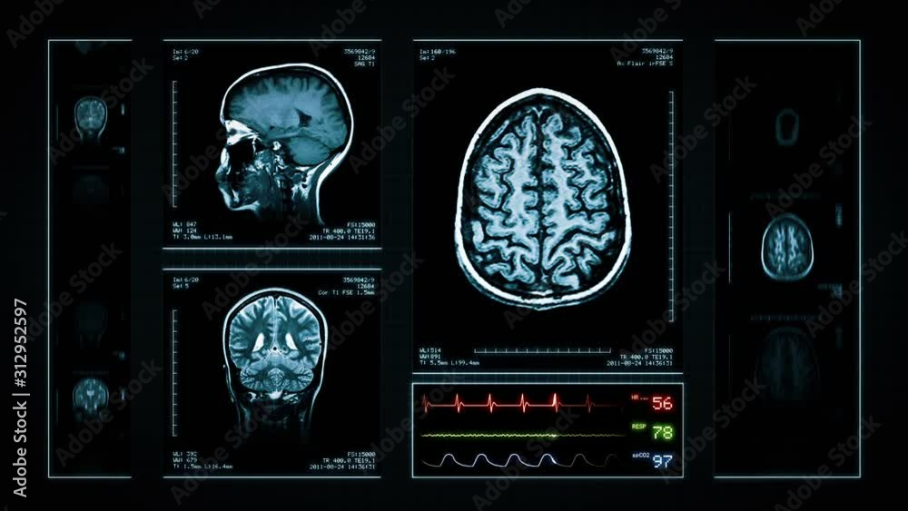 Brain MRI Scan. Blue. 3 videos in 1 file. Animation showing top, front ...