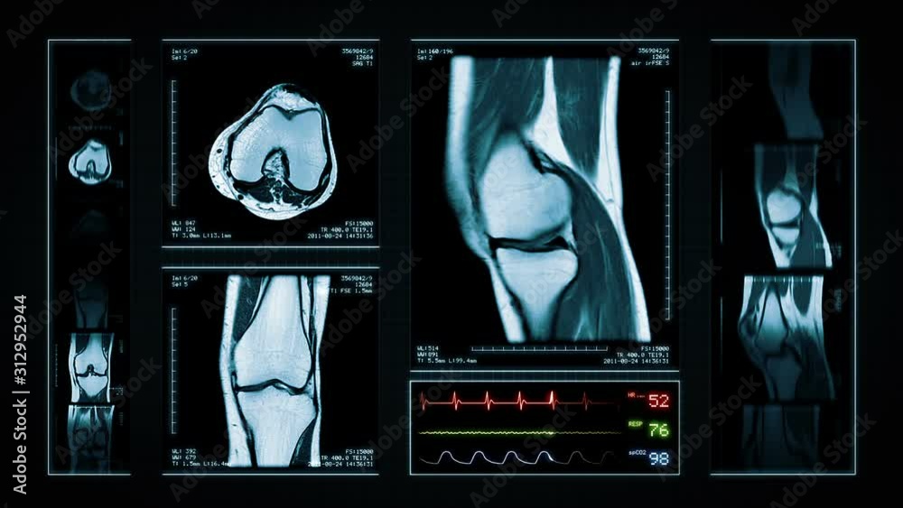 Knee MRI Scan. Blue. 4 videos in 1 file. Animation showing top, front ...