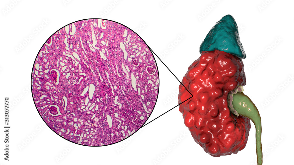 Chronic pyelonephritis, 3D illustration showing gross morphology with ...