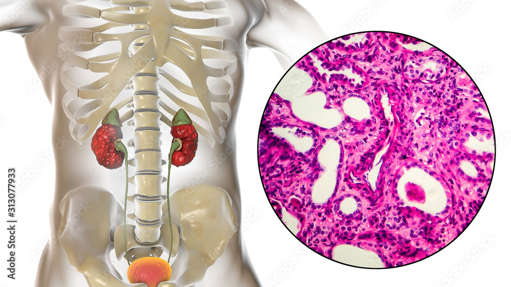 Chronic Pyelonephritis Gross
