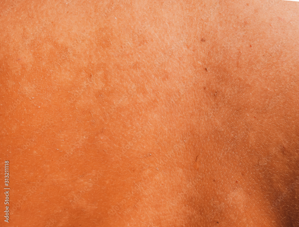 Sunburn on the skin of the back. Exfoliation, skin peels off. Dangerous ...