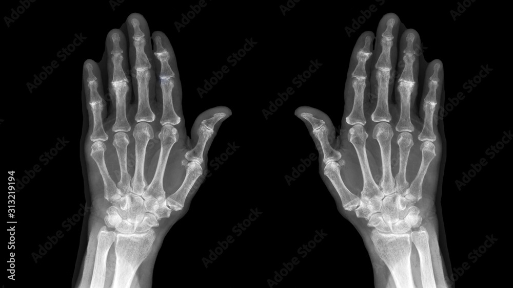 Film X ray hand radiography show degenerative osteoarthritis disease(OA ...