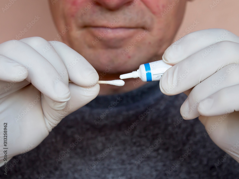 A man with an eye condition. The use of eye ointment for the treatment ...