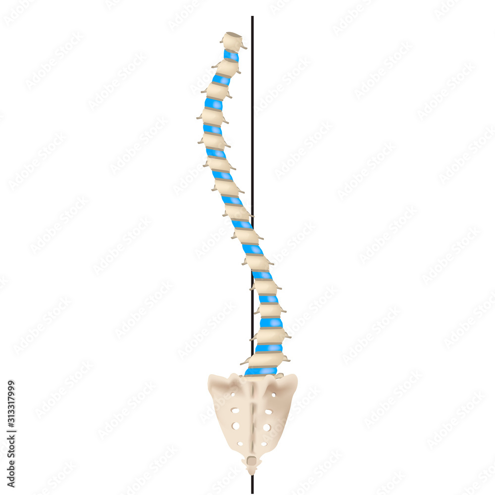S-shaped scoliosis. Dextroscoliosis. Levoscoliosis. Spinal curvature ...