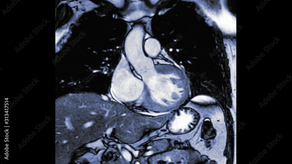 MRI heart or Cardiac MRI magnetic resonance imaging of heart in LVOT ...