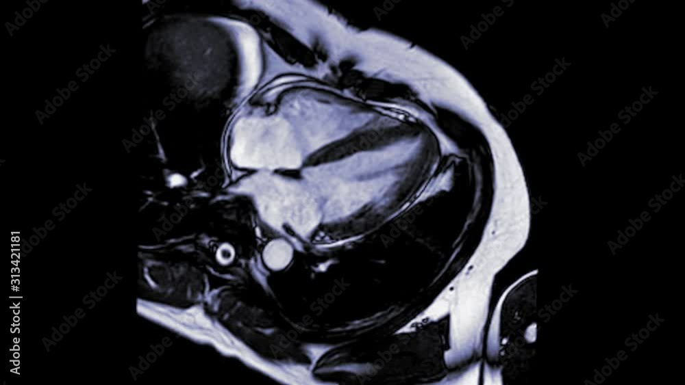 MRI heart or Cardiac MRI magnetic resonance imaging of heart in 4 ...