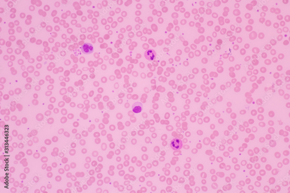 Human blood smear view in microscopy.Complete blood count for treatment ...