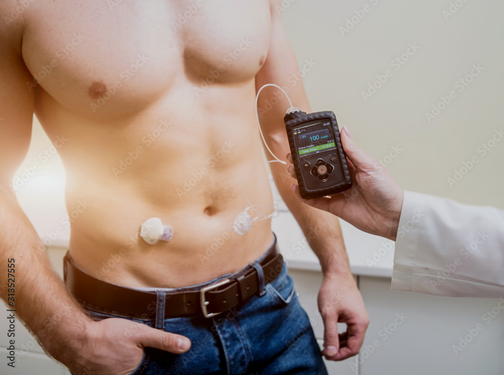 The doctor connects an insulin pump to a patient with diabetes. A ...
