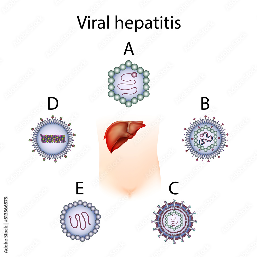 Viral hepatitis. A, B, C, D, E. Medical anatomy illustration. Stock ...