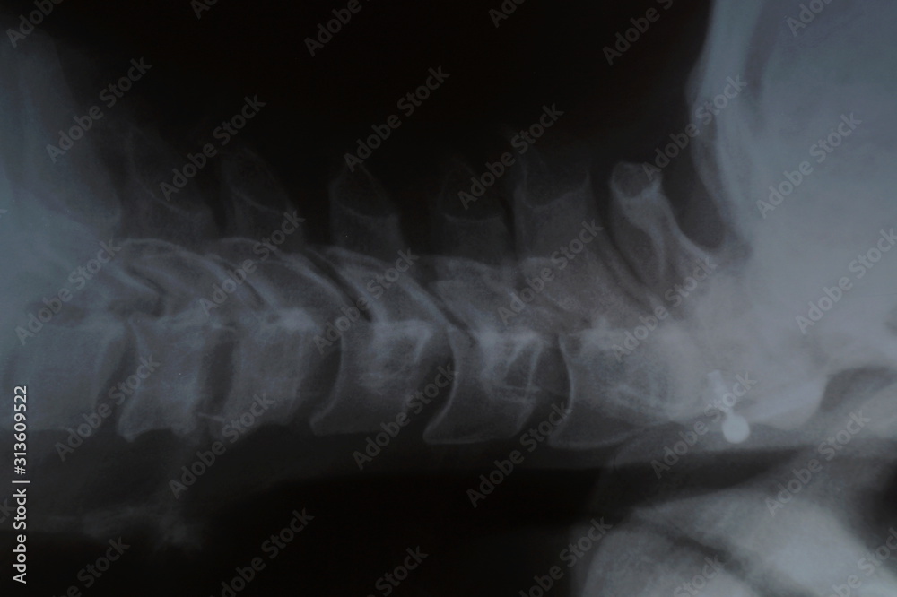 Magnetic resonance image of human spine. X-ray of the spinal column ...