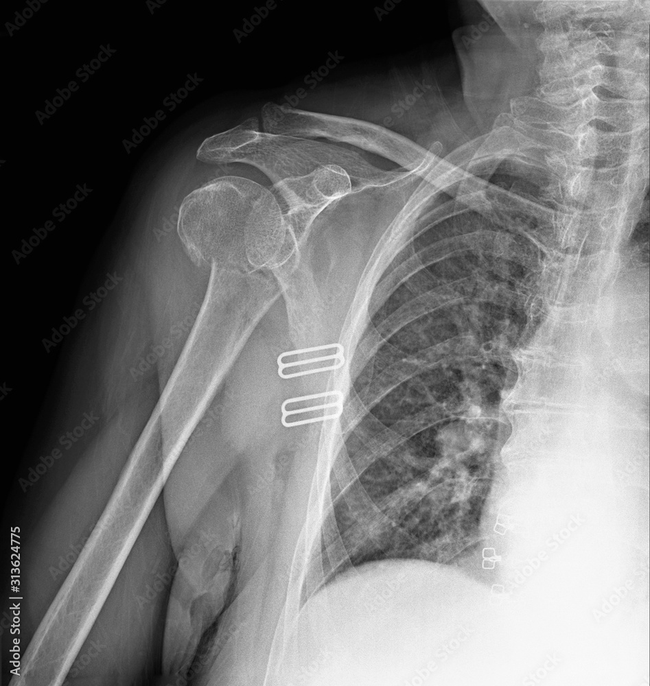 radiography of the shoulder joint in direct projection with a fracture ...