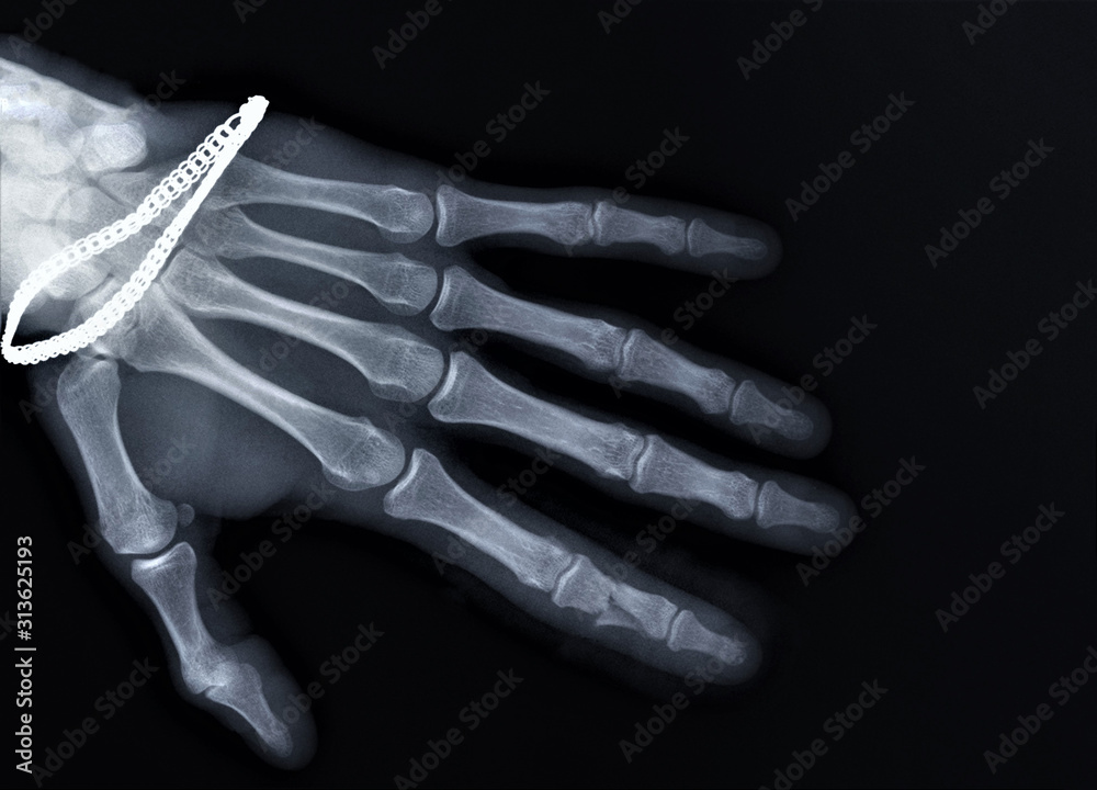 x ray with a fracture of the middle phalanx 2 fingers of the hand Stock ...