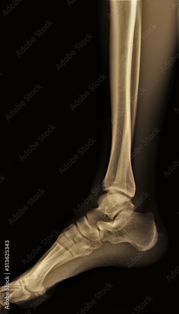 normal radiography of the ankle joint in the lateral projection Stock ...