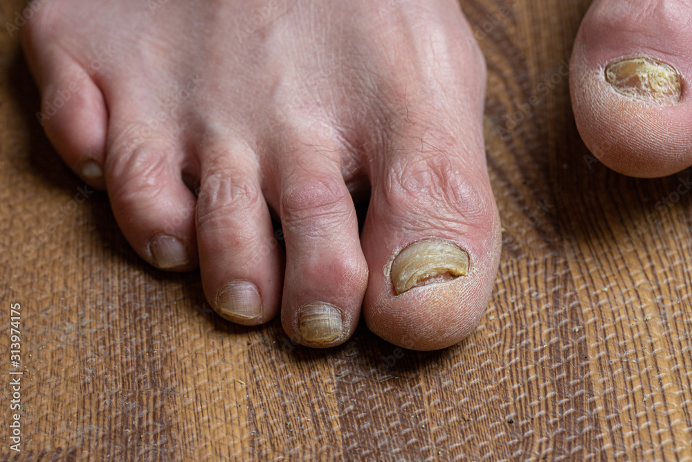 Curled toes on feet of Parkinson's Disease and fungi Stock Photo ...