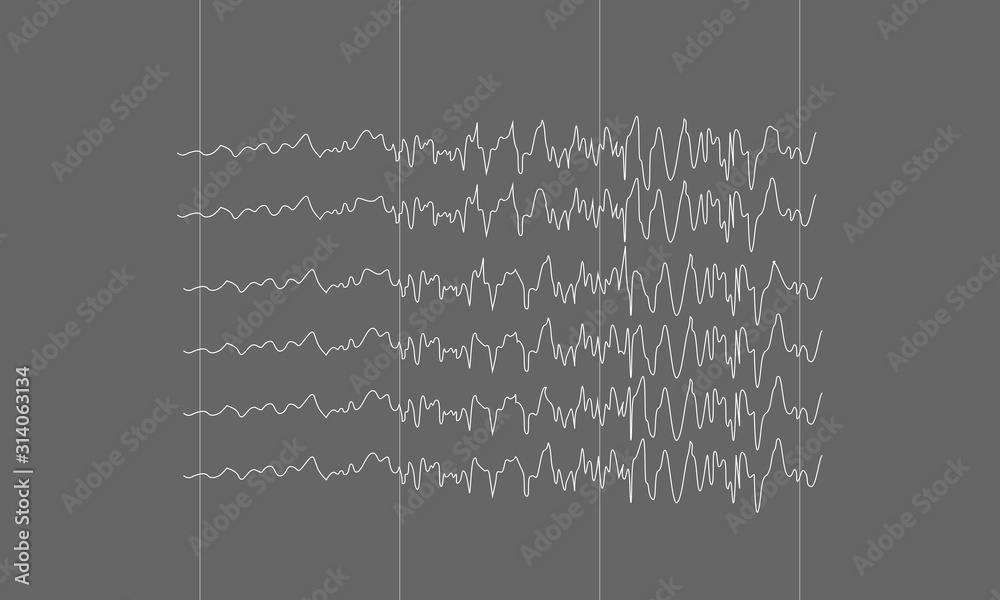 Epileptic seizure brainwaves on black background Stock Vector | Adobe Stock