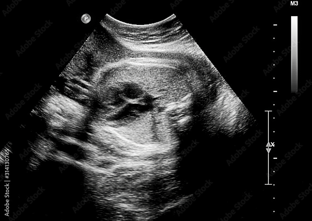 Ultrasound of fetus in third month pregnancy Stock Photo | Adobe Stock