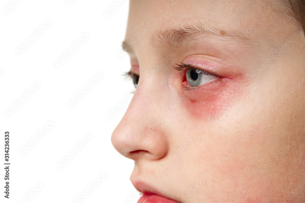Allergic reaction, skin rash, close view portrait of a girl's face ...