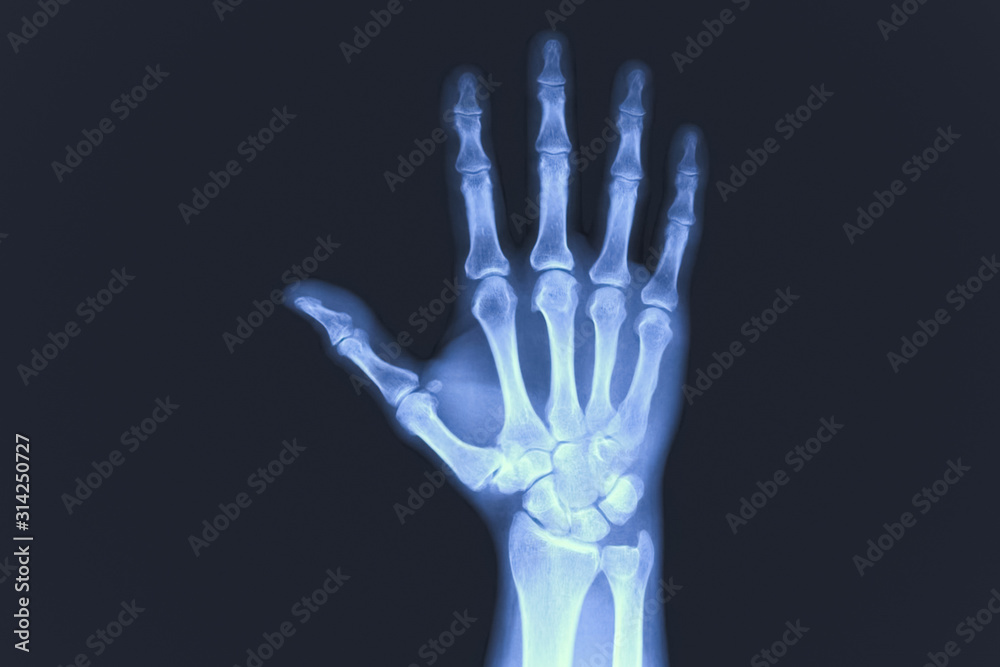 X-rayed human hand. X-ray of hand bones. Stock Photo | Adobe Stock