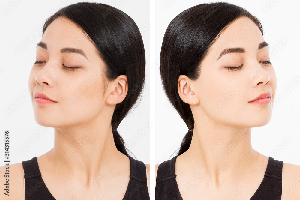 Asian close up woman happy face before after cosmetic procedures. Skin ...