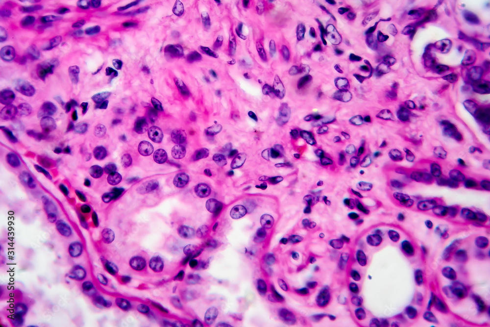 Chronic pyelonephritis, light micrograph, photo under microscope. High ...