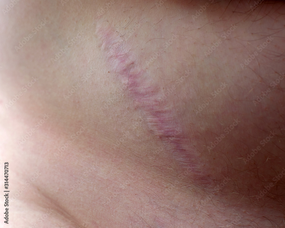scar on a man's body from appendicitis surgery Stock Photo | Adobe Stock