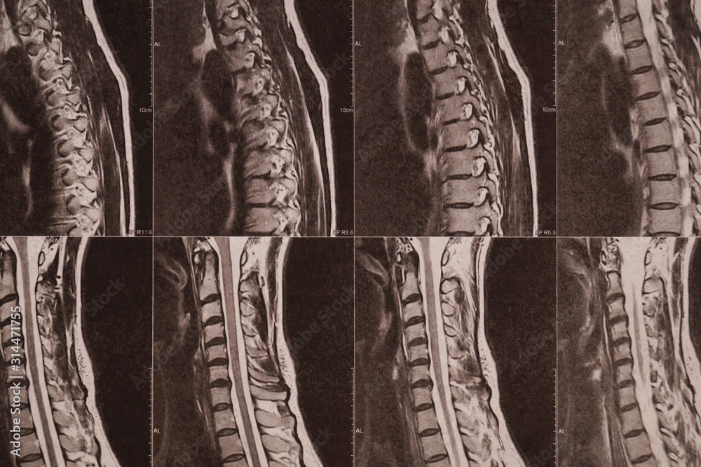 Magnetic resonance image of human spine, disc herniation and ...