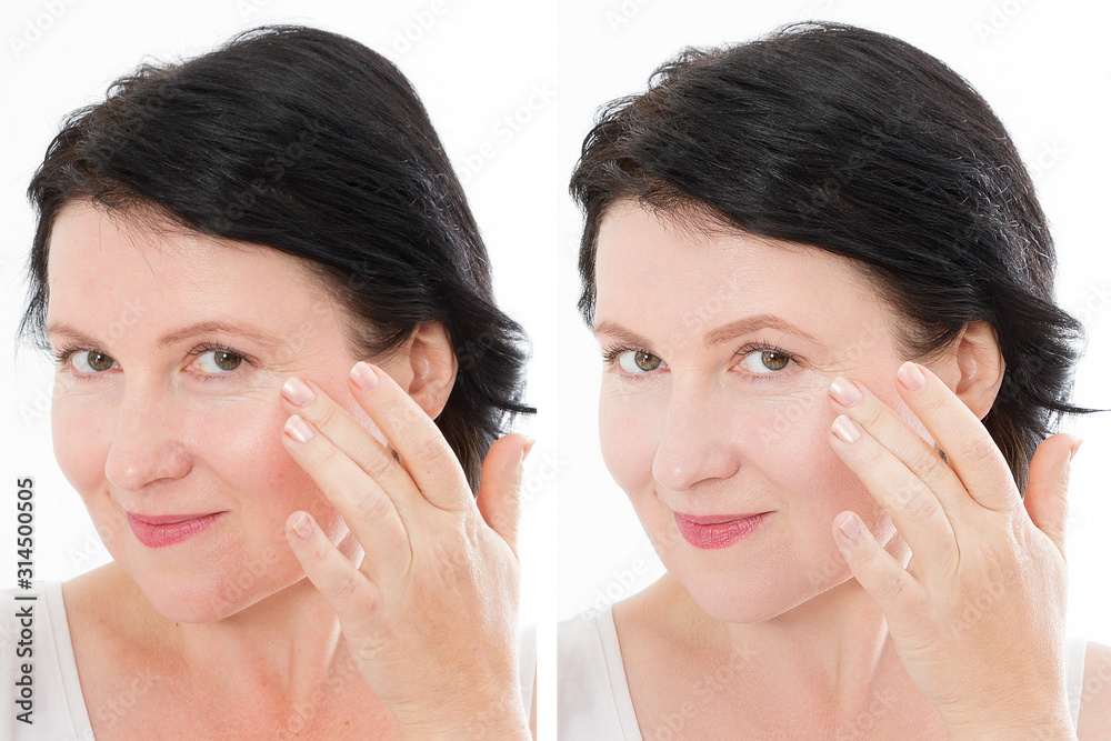 Middle age close up woman happy face before after cosmetic procedures ...