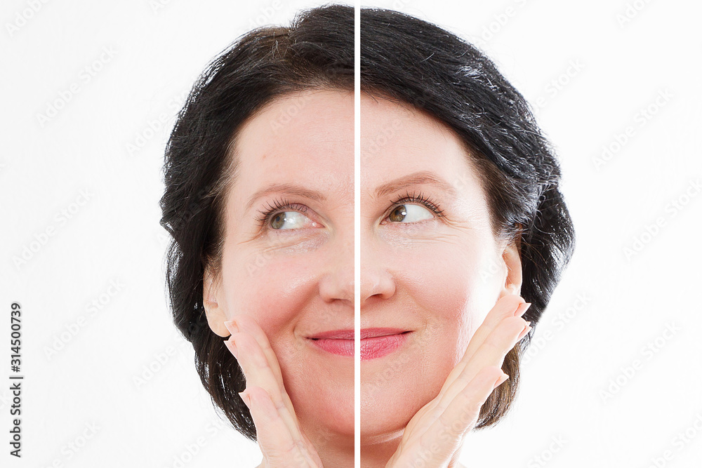 Close up before after skin Beauty middle age woman face portrait. Spa ...