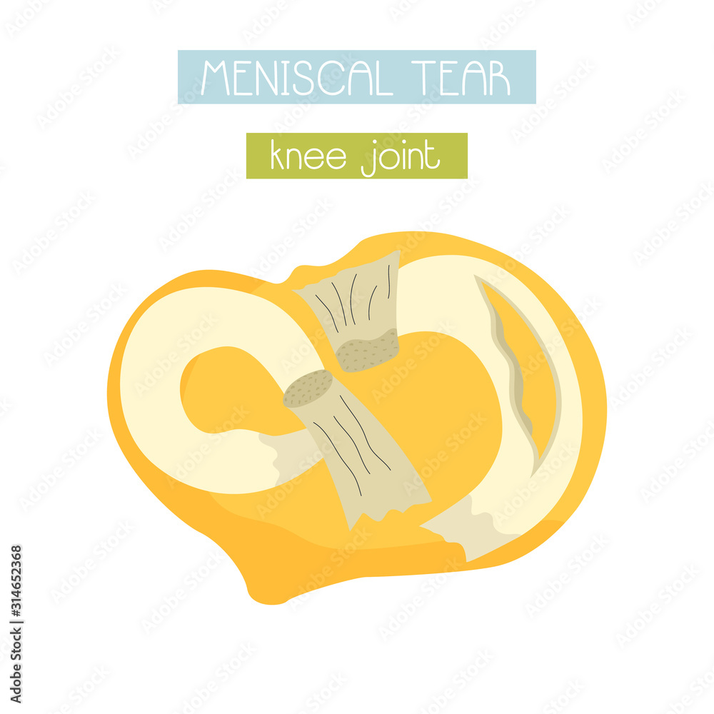 Poster vector illustration of meniscal tear of knee joint – Wall Art ...