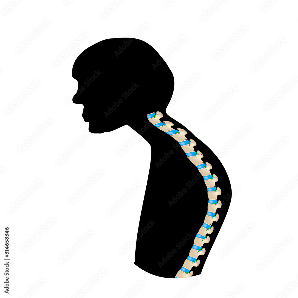 The position of the spine with kyphosis. Black and white silhouette ...