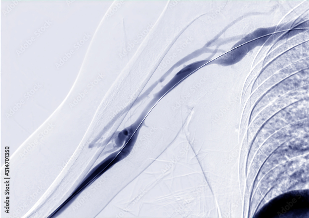 Angioplasty, balloon angioplasty and percutaneous transluminal ...