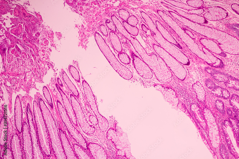 Breast Cancer Cells Under Microscope