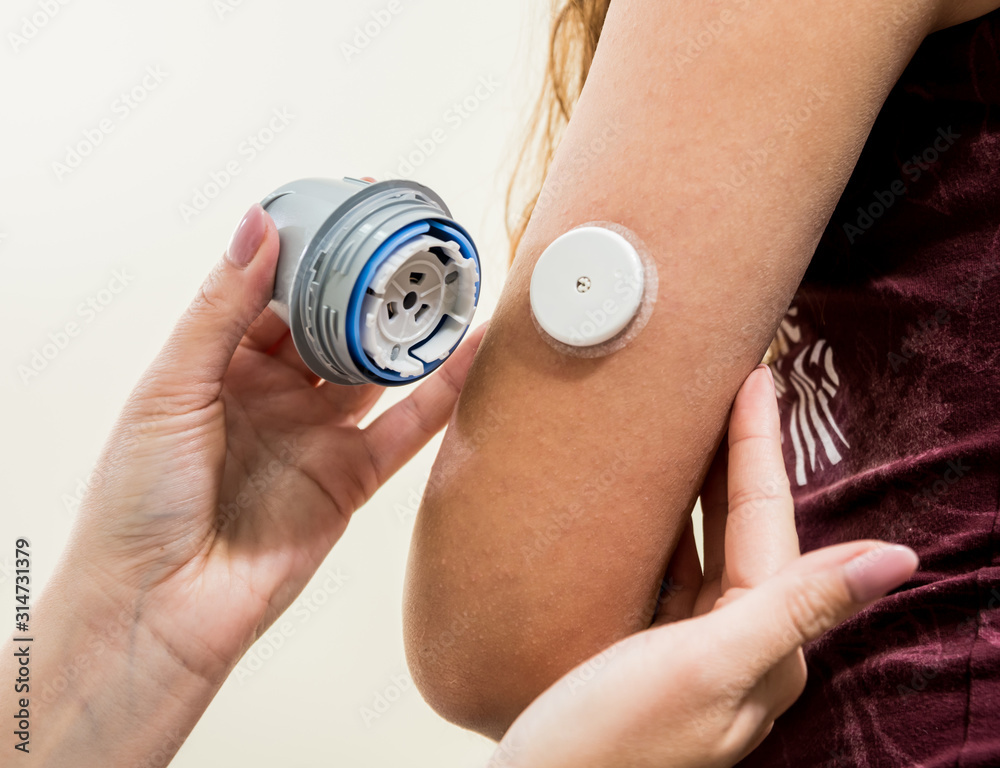 Medical device for glucose check. Continuous glucose monitoring pod ...