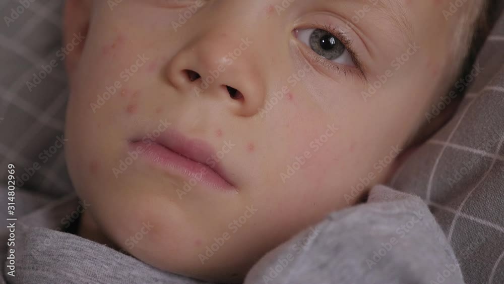 Close-up portrait of a little sad sick boy in bed with chicken pox. The ...