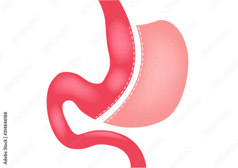 laparoscopic gastrectomy Gastric Sleeve / weight loss surgery vector ...