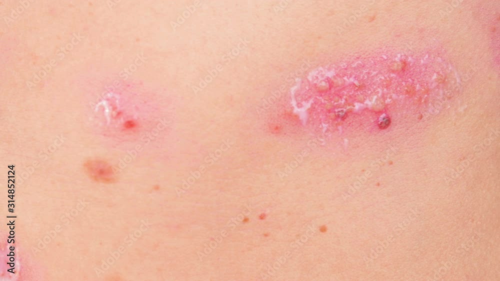 skin rash treatment on woman body. Shingles, Disease, Herpes zoster ...