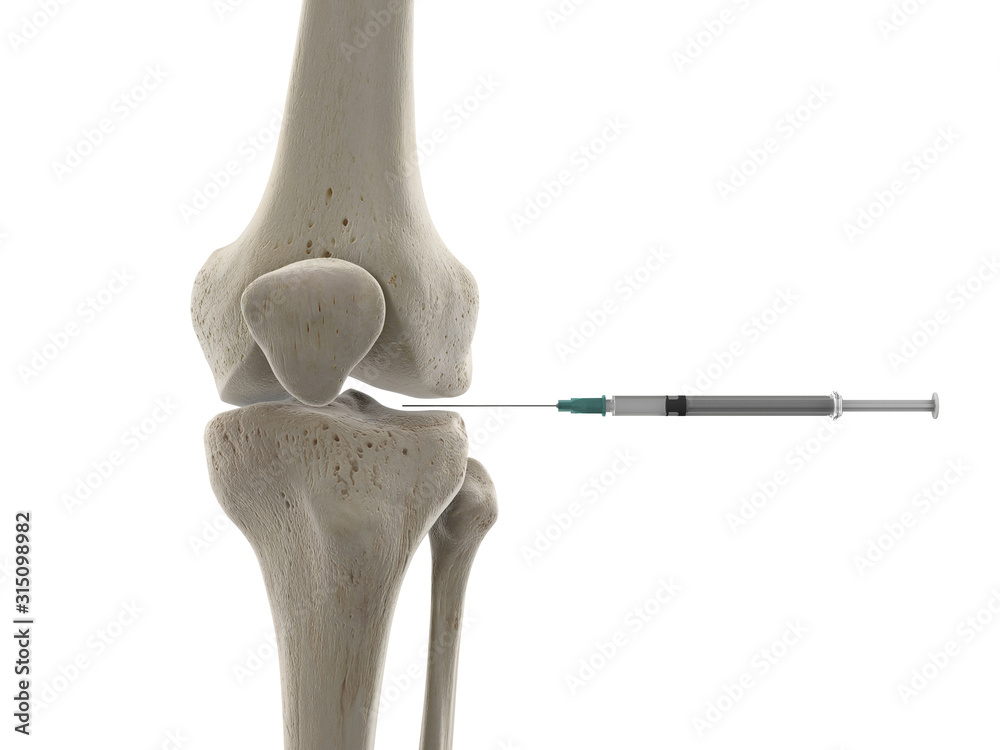 3d rendered medically accurate illustration of a knee joint injection ...