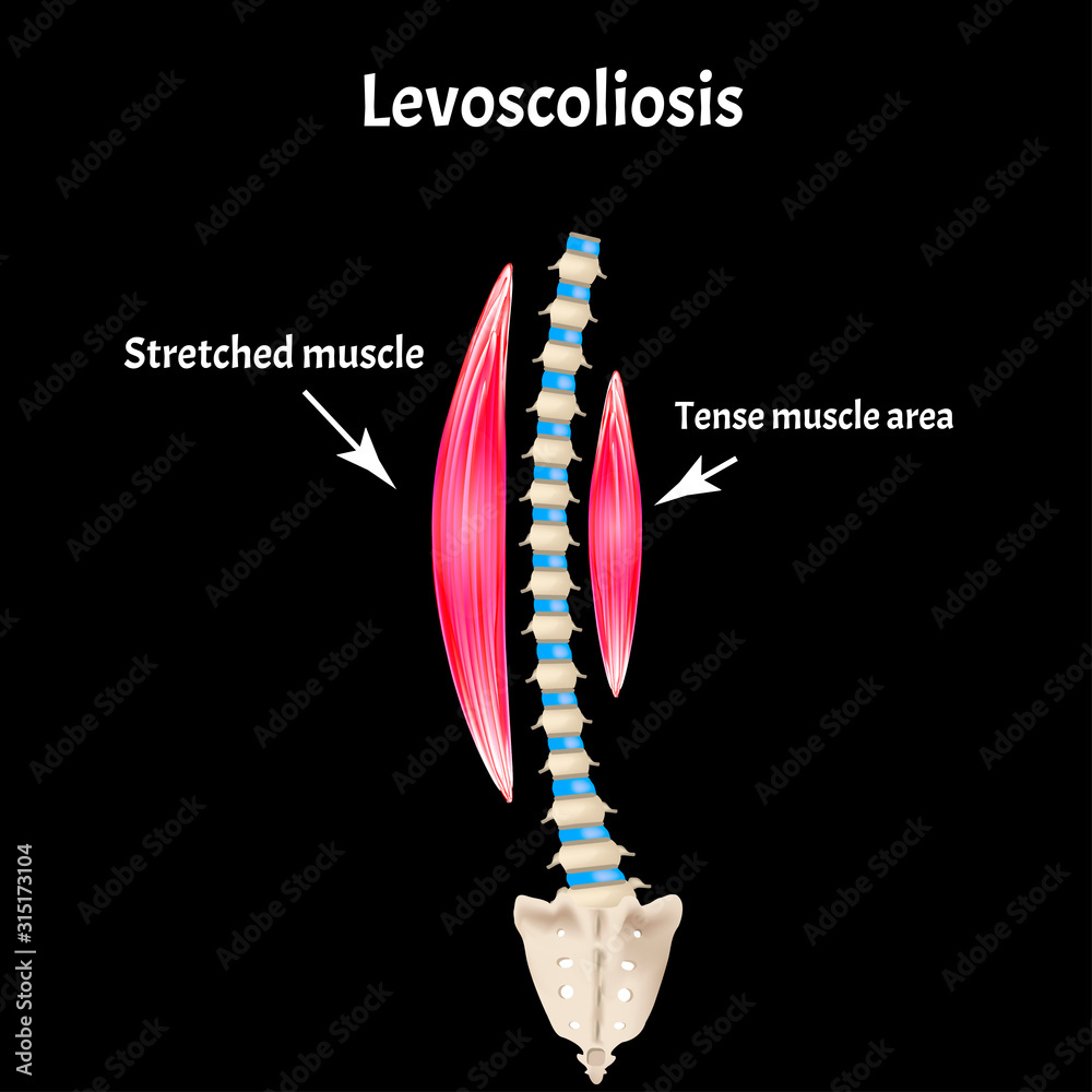 Left-sided scoliosis. Levoscoliosis. Muscles and spine. Spinal ...