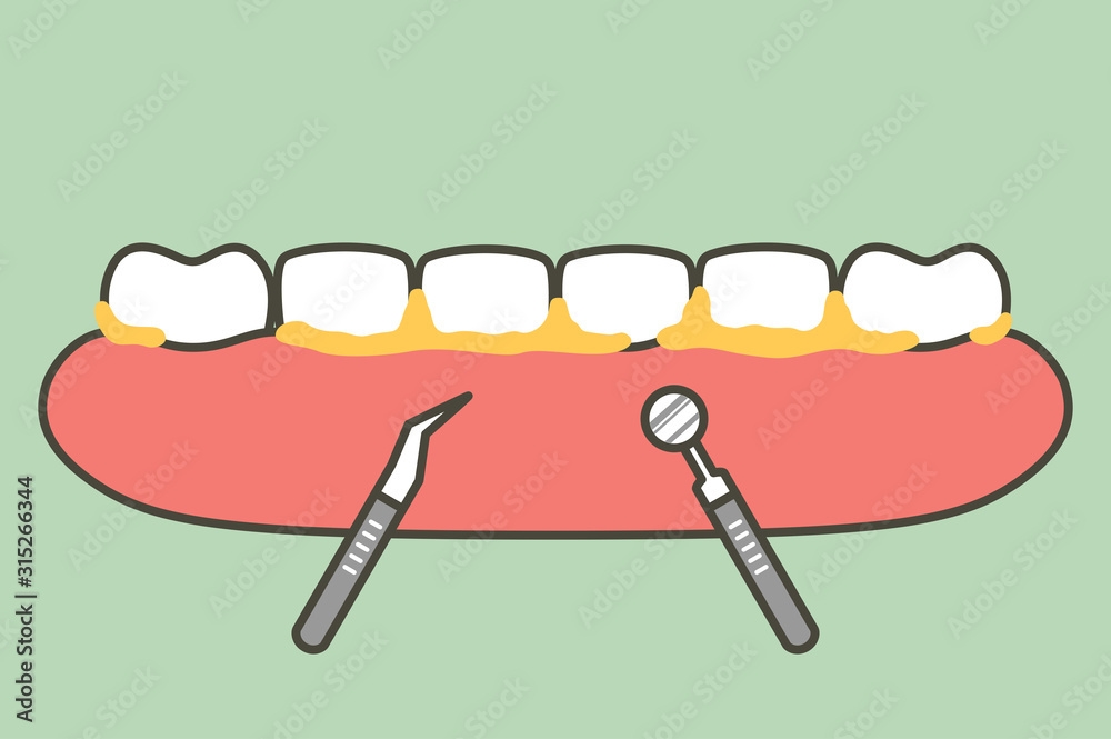 teeth scaling, dental plaque removal for cleaning - tooth cartoon ...