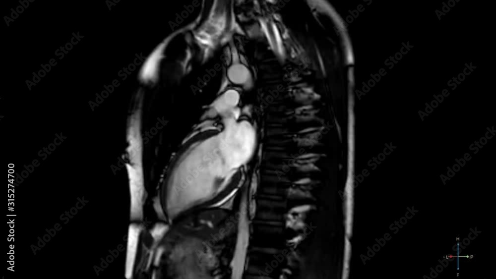 Medical Tomography Mri Scan Of Young Man Beating Heart, Black and White ...