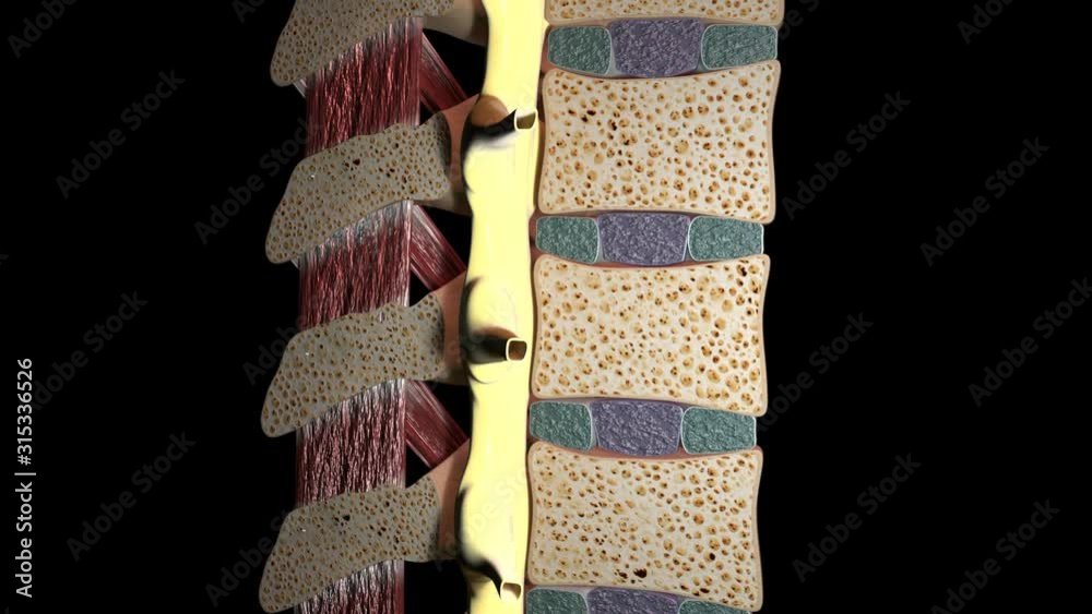 Herniated Disc Section View Stock Video | Adobe Stock