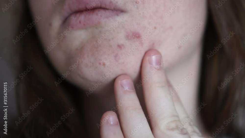 Girl with Skin Problems, Close-up of a woman's face. The girl touches ...