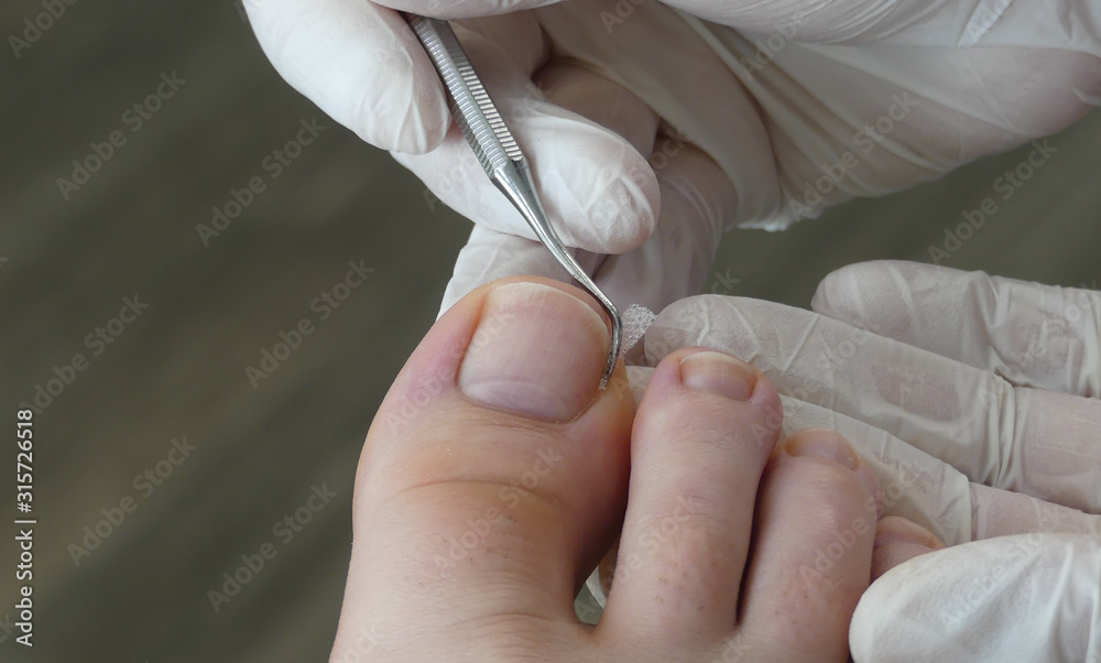 Podiatry, Chiropodist, medical foot care, podiatrist, ingrown toenail ...