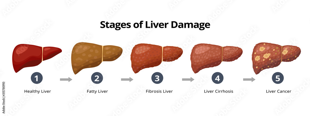Stages of liver damage from healthy, fatty liver, fibrosis, cirrhosis ...