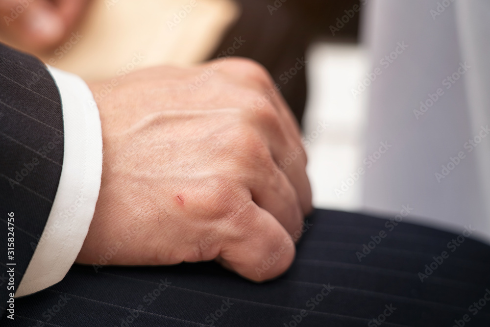 Bussiness man showing a little lesion on his hand, Accident wounded ...