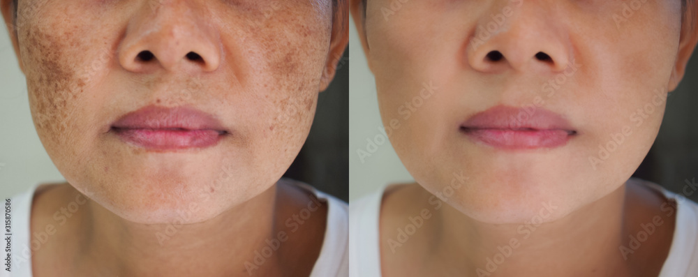 Image before and after spot melasma pigmentation facial treatment on ...